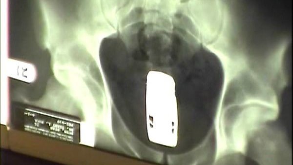 15 Strangest Things Found In People's Butts In 2014 – Page 6